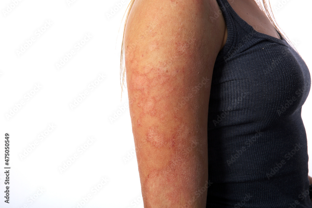 Symptoms of a pulp on the skin of a young woman Stock Photo | Adobe Stock