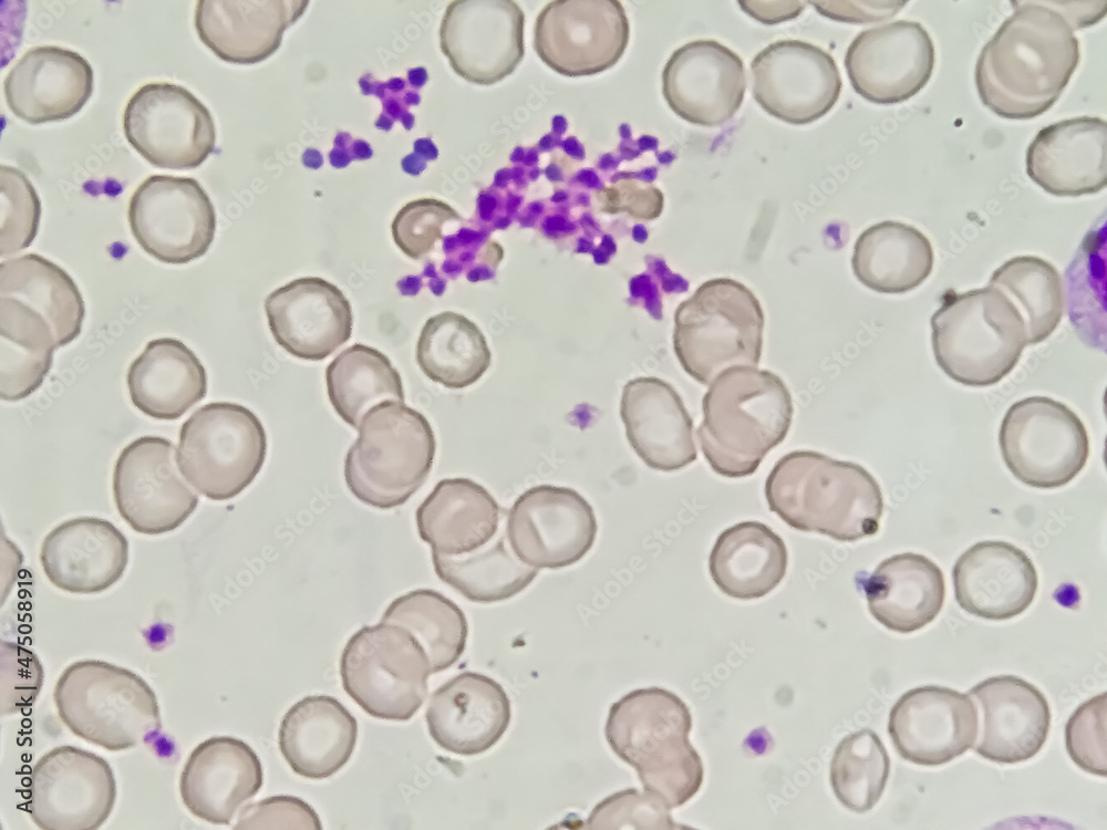 Essential thrombocytosis blood smear showing abnormal high volume of ...