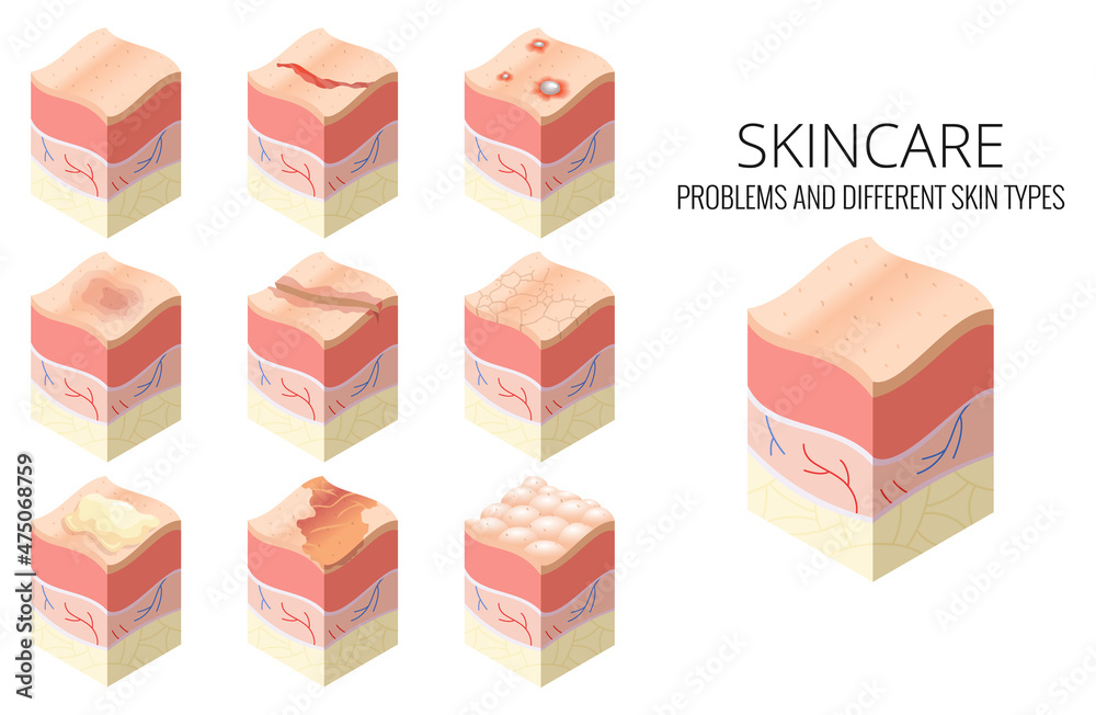 Skincare medical concept. Set of problems of different skin types in ...