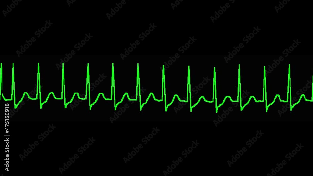 ecg arrhythmia animation supraventricular tachycardia (SVT) Stock Video ...