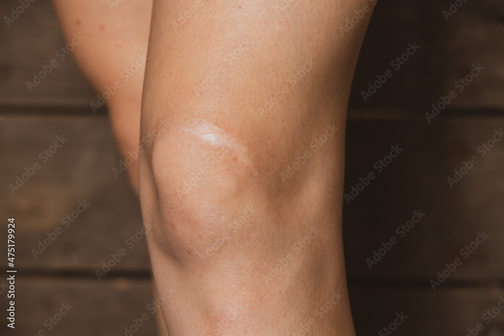knees of a young white-skinned girl with a scar closeup Stock Photo ...