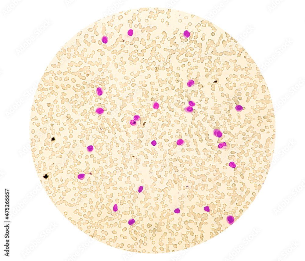 Leuco-erythroblastic anaemia and Chronic myelomonocytic leukemia (CMML ...