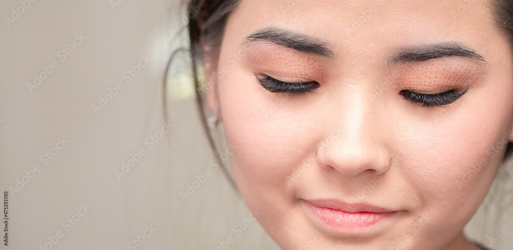 Cosmetic procedure for lifting the skin of the eyelids of Asian eyes ...