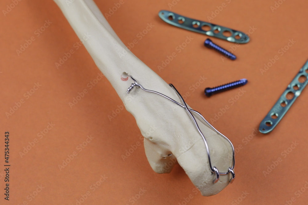 Surgical instruments for operation bone fractures Stock Photo | Adobe Stock
