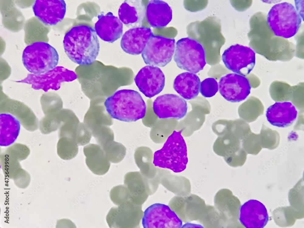 Chronic myeloid leukemia cells or CML, analyze by microscope, original ...