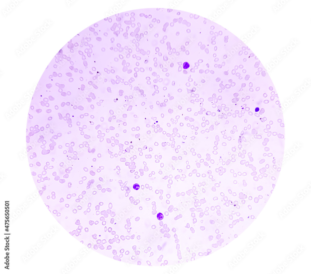 Macrocytic anemia with features of hemolysis and nucleated RBC analyzed ...