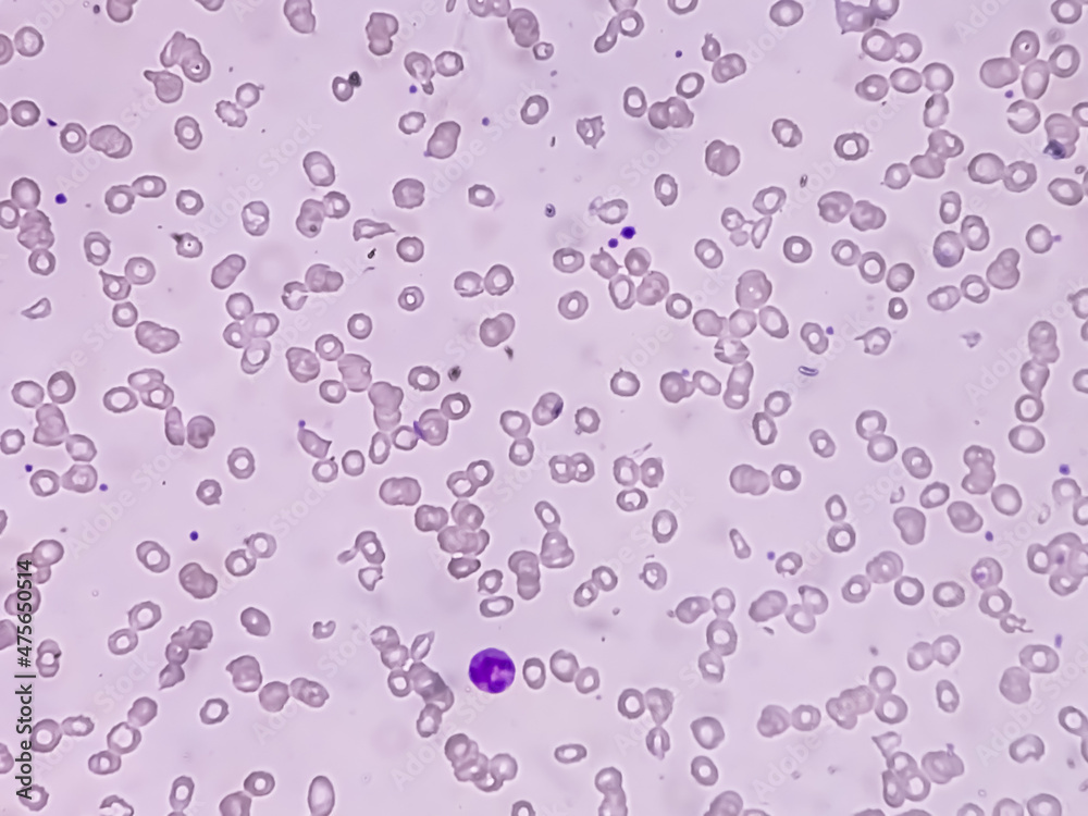 Macrocytic anemia with features of hemolysis and nucleated RBC analyzed ...