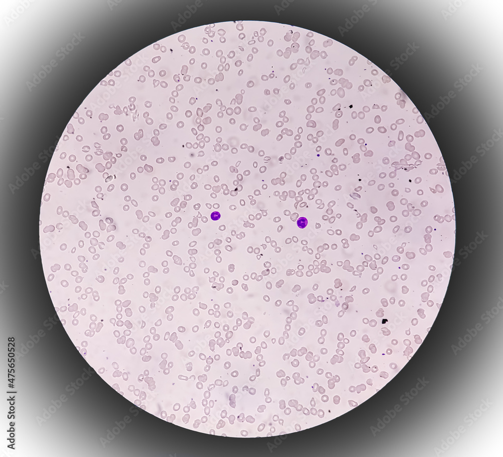 Dimorphic anemia analyzed by microscope. It is also called iron ...