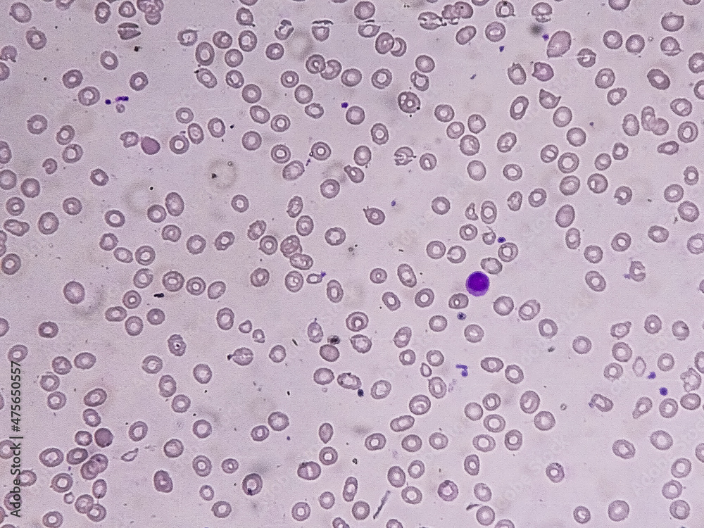 Macrocytic anemia with features of hemolysis and nucleated RBC analyzed ...
