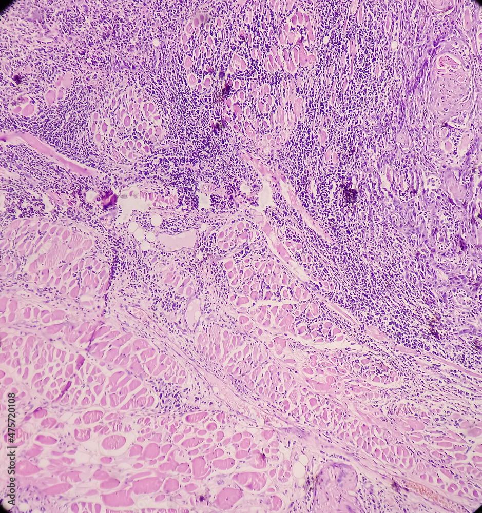 Tongue with mandible cancer, oral cancer, Invasive squamous cell ...