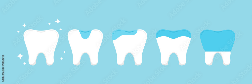 Tooth dental inlay, onlay, overlay and crown treatment set. Teeth ...