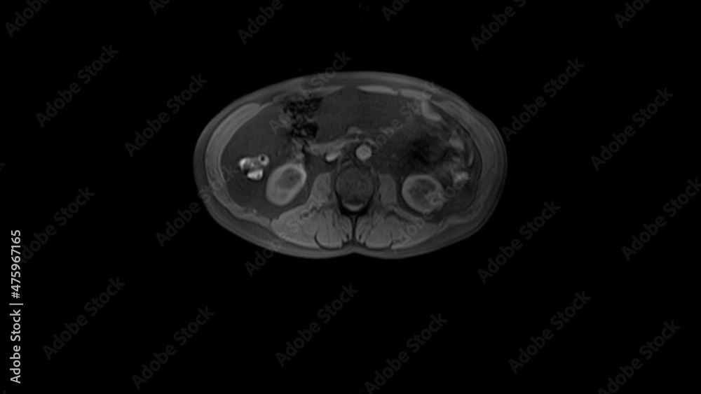 CT scan of the abdomen. Computed tomography of the gastrointestinal ...