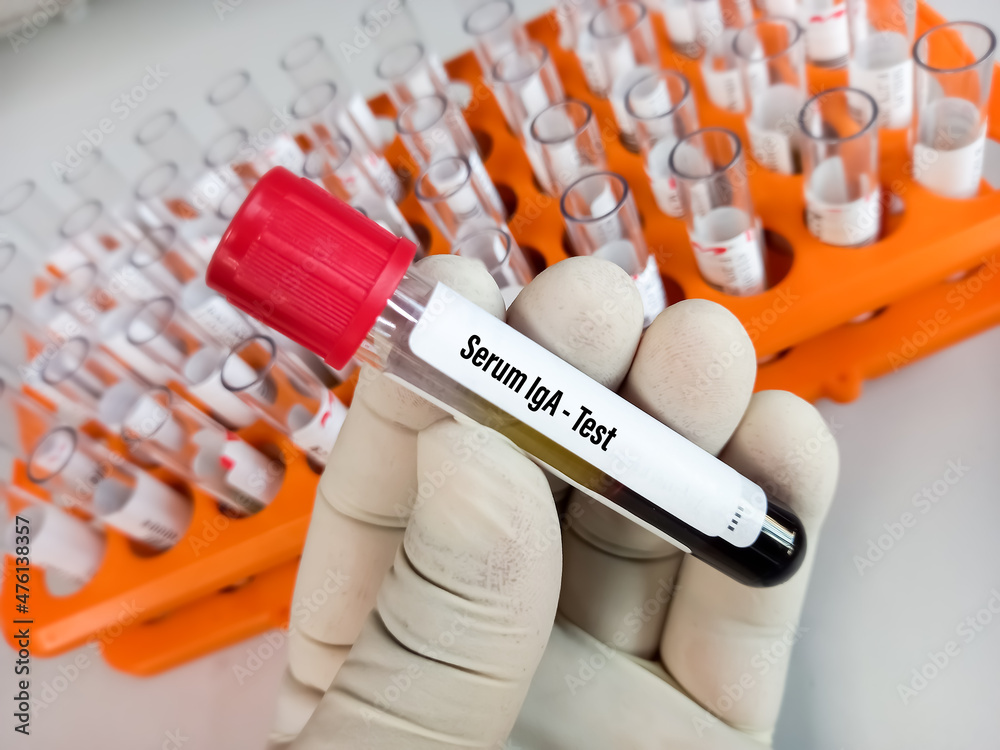 Laboratory blood test sample for Serum Immunoglobulin A(IgA) test, to ...