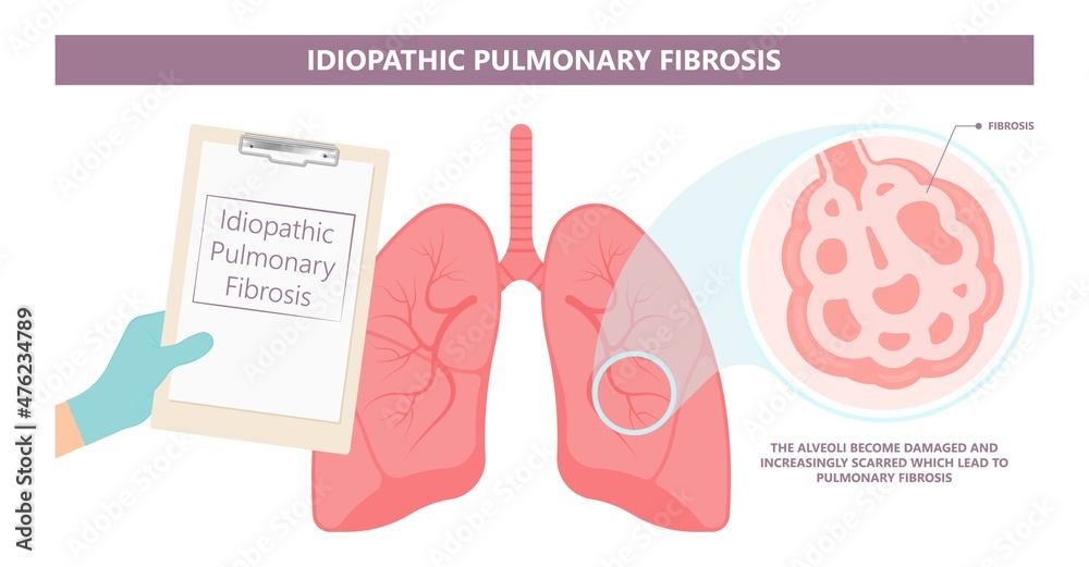 Capillary dry cough of wood metal dust breath virus Chest X-ray Cancer ...