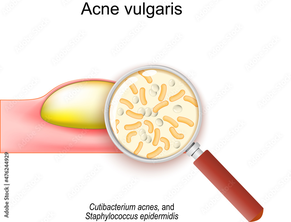 Acne vulgaris. Cross-section of a human skin with pimple. Magnifying glass and bacteria 素材庫向量圖 ...