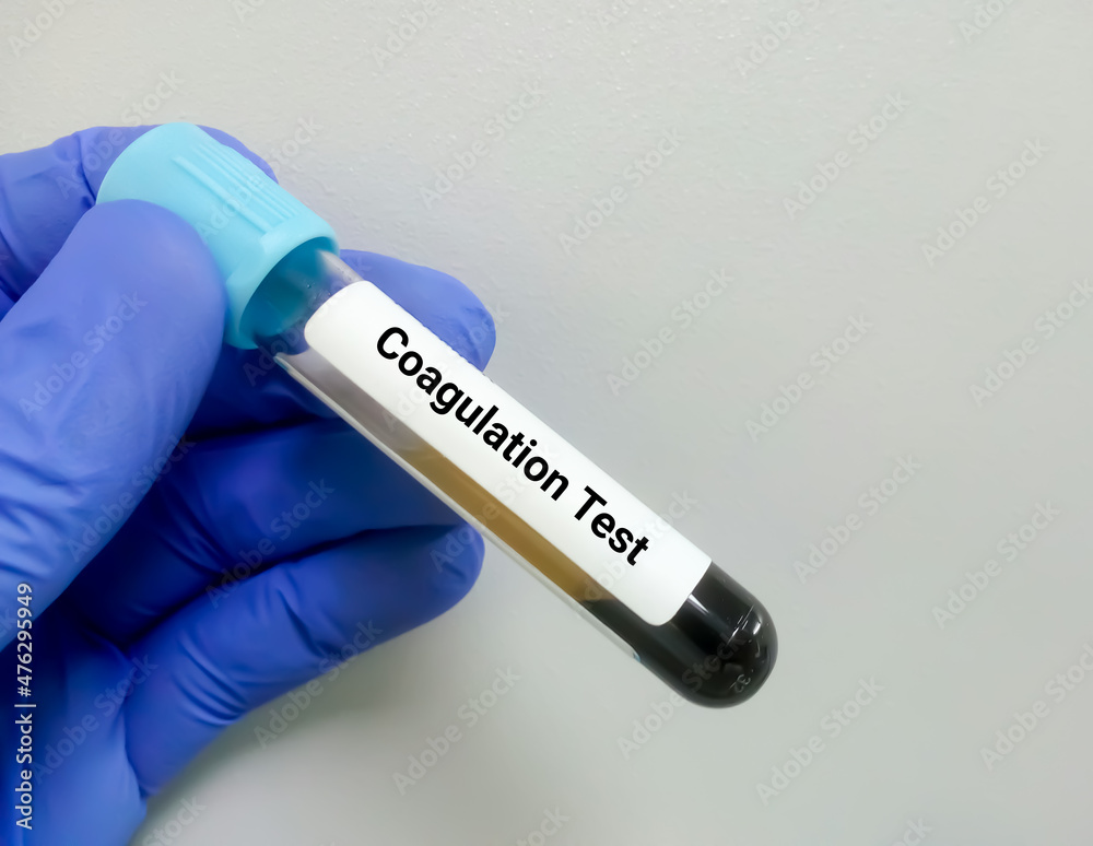 Blood sample for coagulation testing, PT, APTT Stock Photo | Adobe Stock