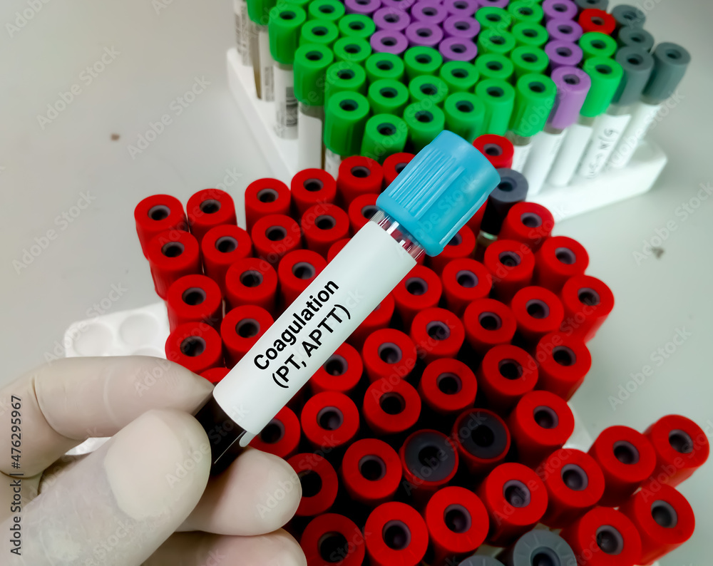 Blood sample for coagulation (PT, APTT) testing, diagnosis of bleeding ...