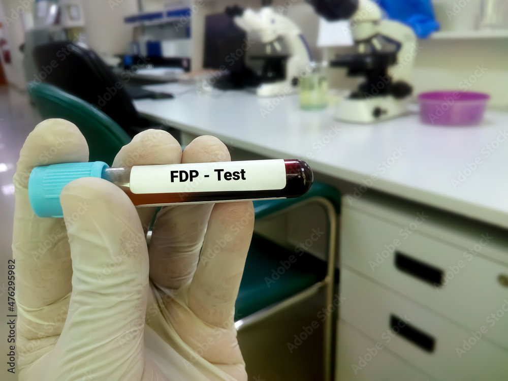 Technician hand blood tube for FDP test. Fibrin degradation product ...