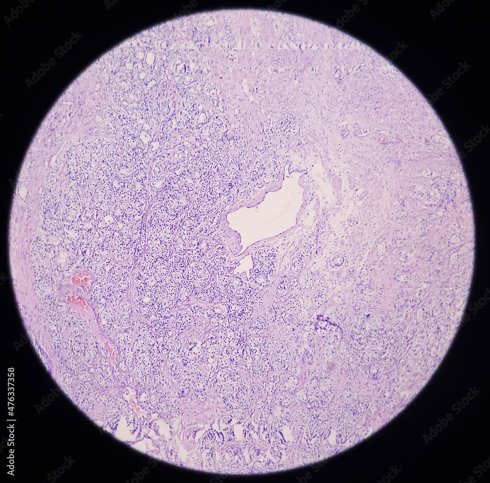 Prostatic chips: Microphotograph show focal area of adenocarcinoma ...