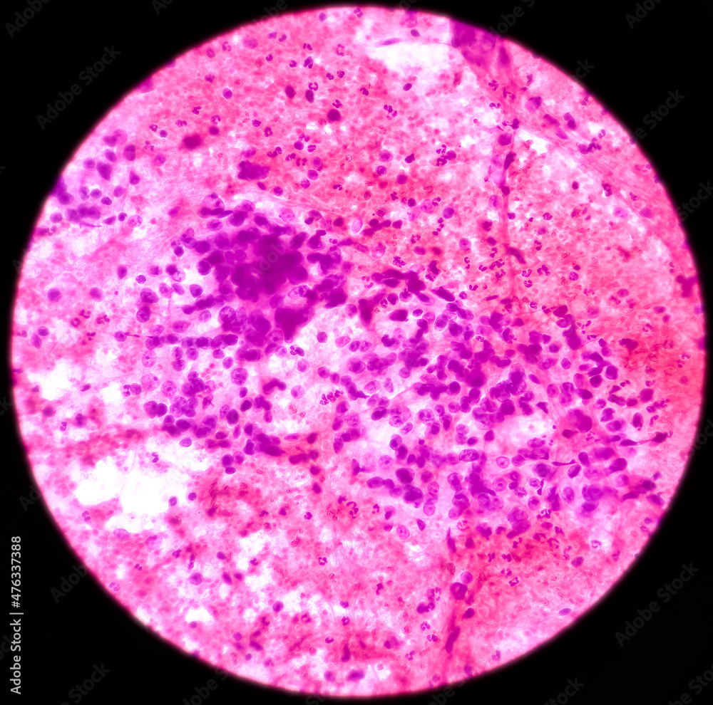 Pancreatic mass(CT Guided FNA): Positive malignant cell, adenocarcinoma ...
