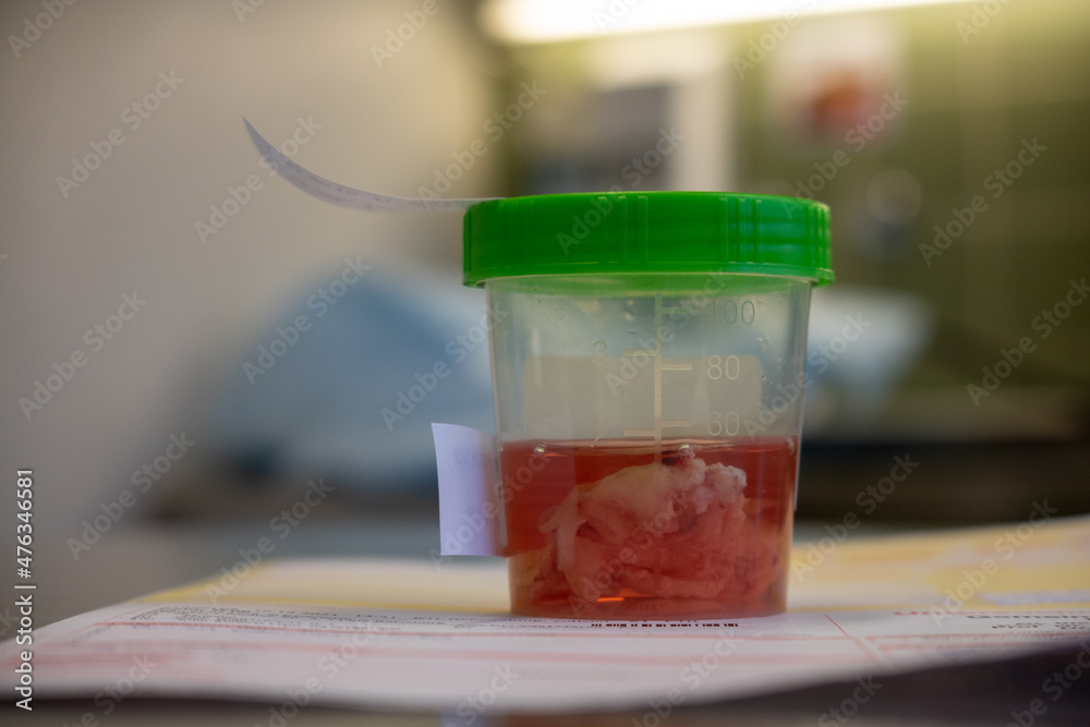 tissue sample is placed in a formalin-filled cup after an operation ...