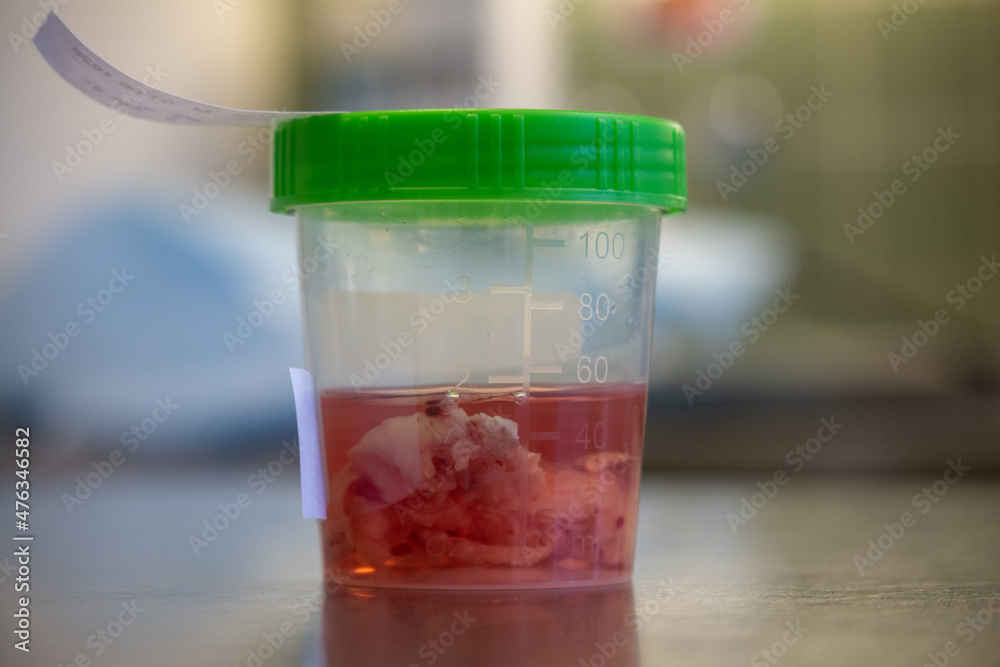 tissue sample is placed in a formalin-filled cup after an operation ...