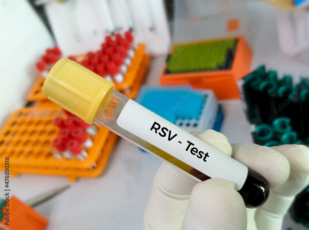 Blood sample for respiratory syncytial virus (RSV) test Stock Photo ...