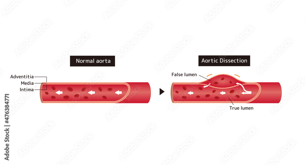 Comparison illustration of normal aorta and aortic dissection Stock ...