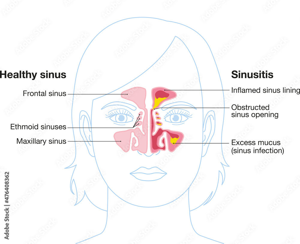 Healthy sinus and sinusitis, medical illustration Stock Illustration ...