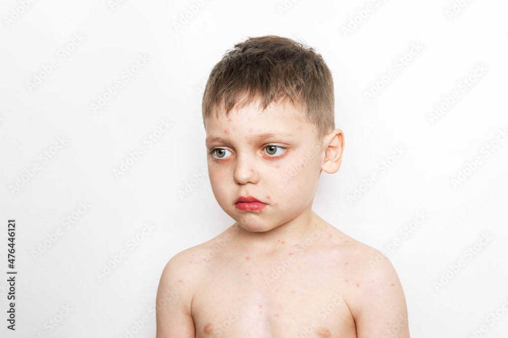 A portrait of a child with a red rash on his body isolated on a white ...