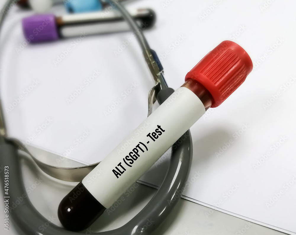 Blood sample for Serum ALT (SGPT) test. Liver function test Stock Photo ...