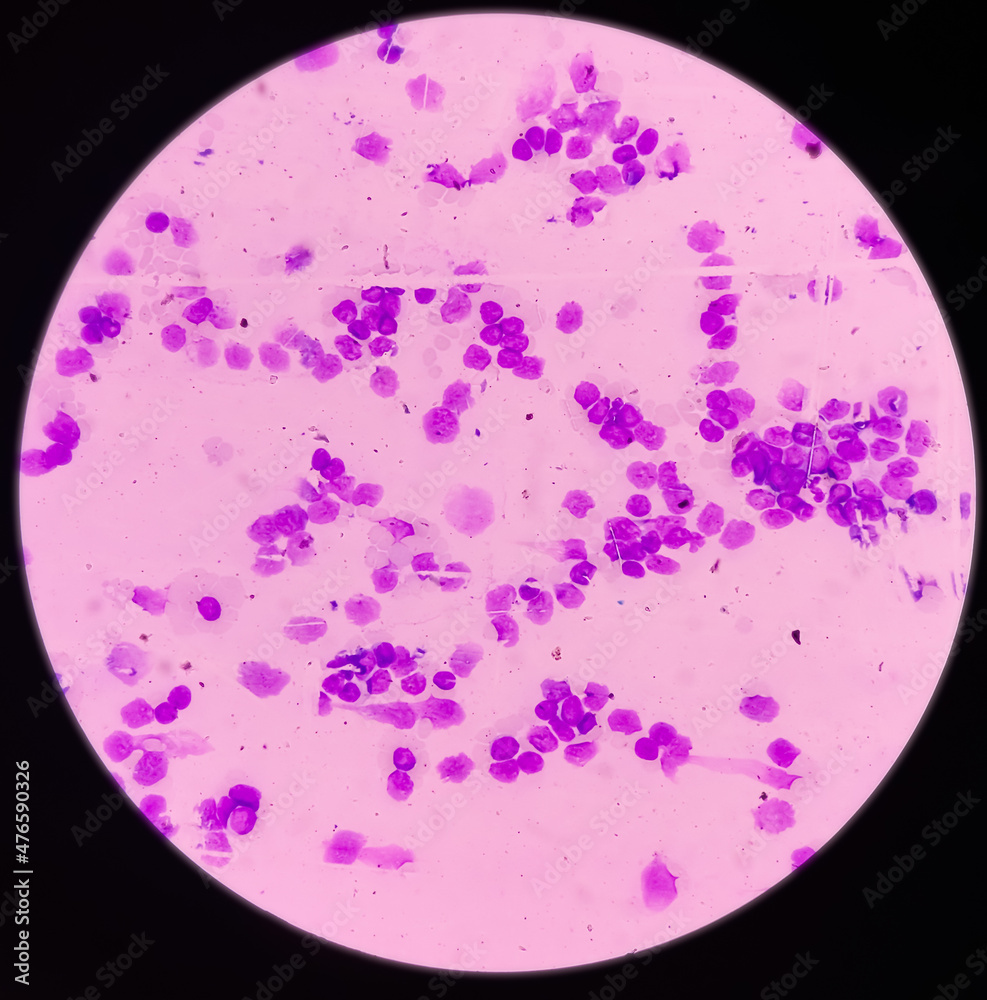 Chronic myeloid leukemia (CML) is a type of blood cancer. Microscopic ...