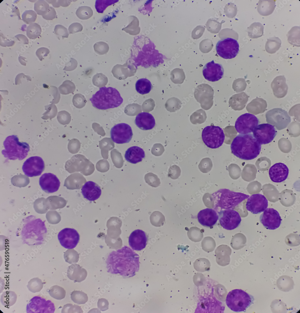 Chronic myeloid leukemia (CML) is a type of blood cancer. Microscopic ...