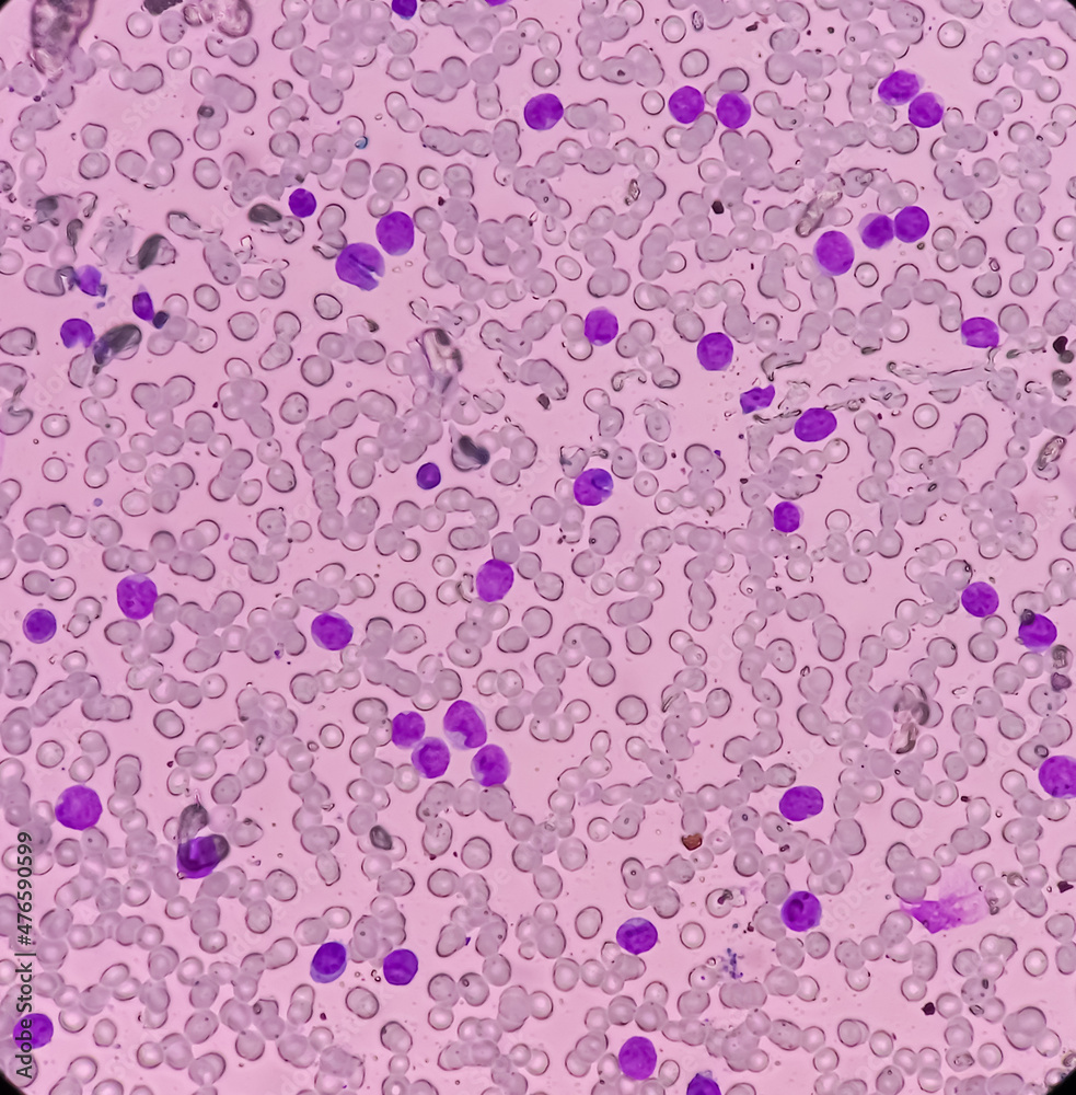 Chronic myeloid leukemia (CML) is a type of blood cancer. Microscopic ...