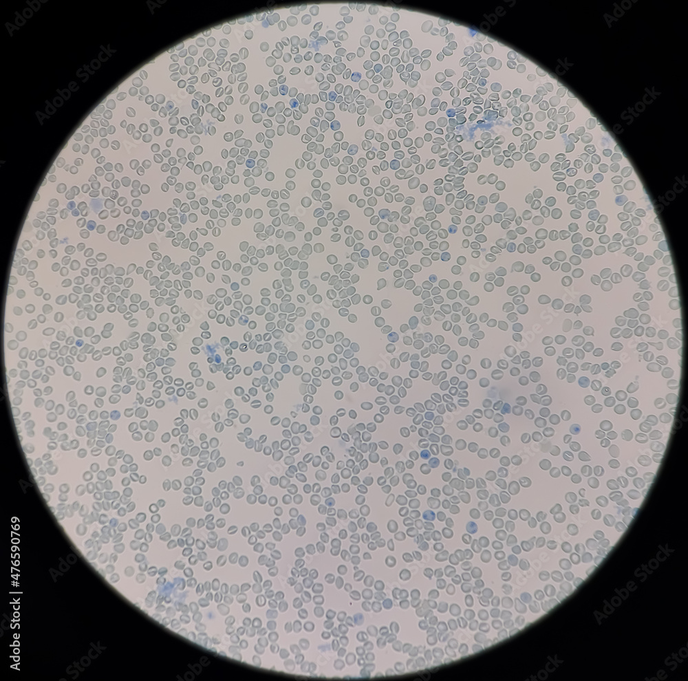 Reticulocyte count under microscope, 100x. methylene blue staining ...