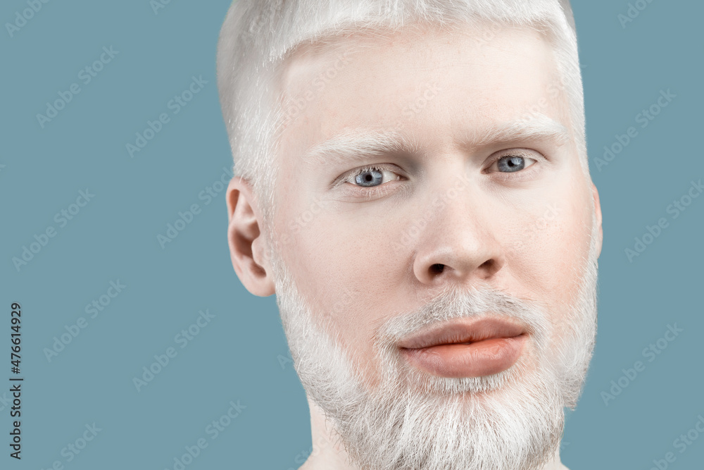 Albinism concept. Portrait of young bearded albino man with white hair ...