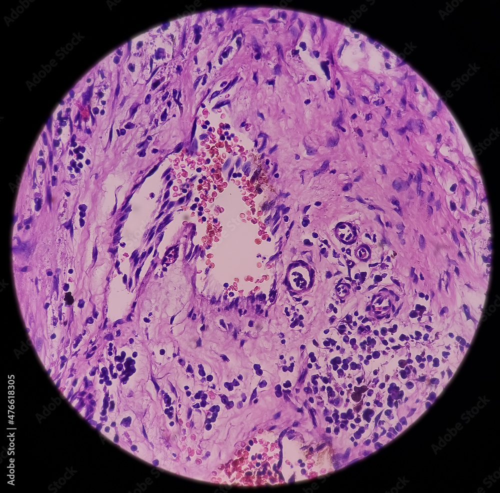 Ear and mastoid(biopsy): Microphotograph of Cholesteatoma, show ...