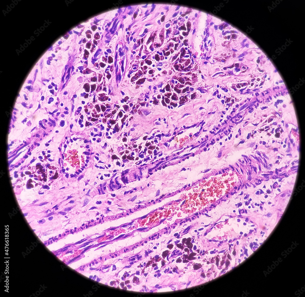 Ear and mastoid(biopsy): Microphotograph of Cholesteatoma, show ...