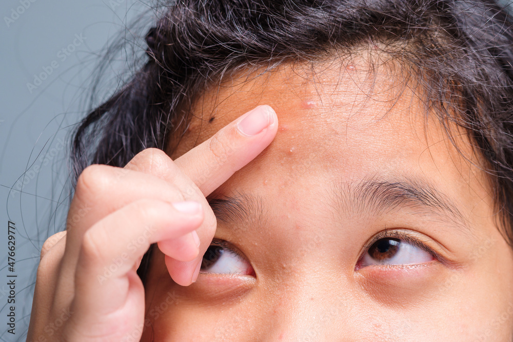 Closeup acne pimple on the forehead of child, eleven years old girl has ...
