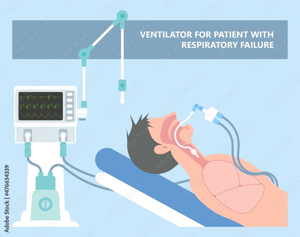 Acute respiratory distress syndrome (ARDS) a respiratory failure and ...