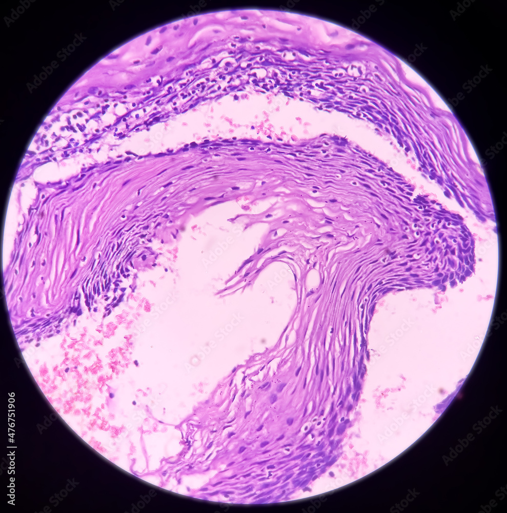 Pyriform fossa cancer: Invasive squamous cell carcinoma, moderately ...