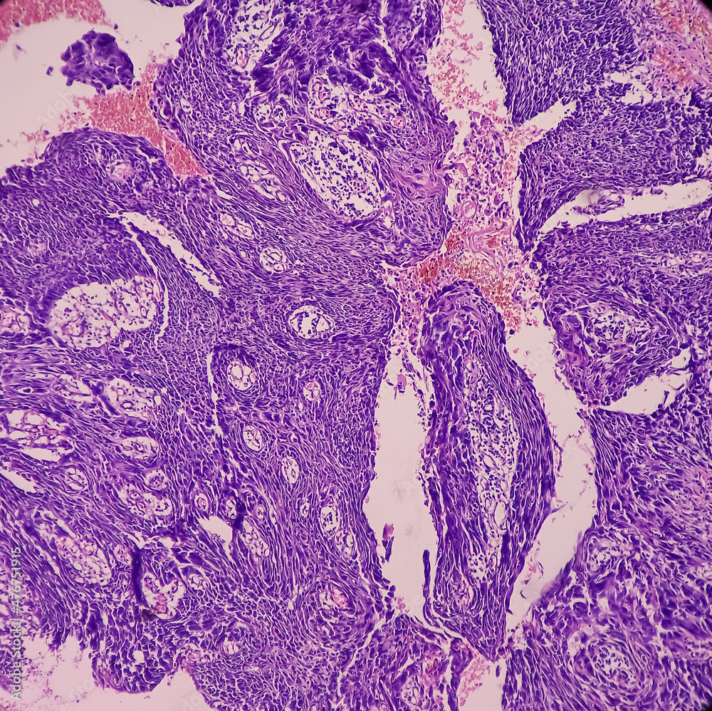 Pyriform fossa cancer: Invasive squamous cell carcinoma, moderately ...