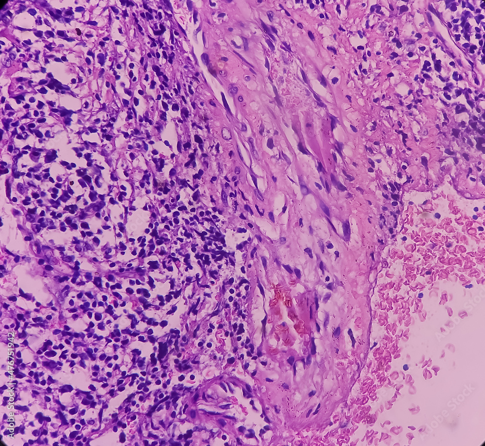 Pyriform fossa cancer: Invasive squamous cell carcinoma, moderately ...