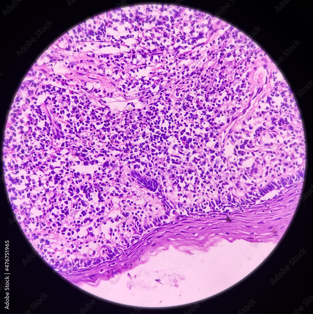 Foto de Pyriform fossa cancer: Invasive squamous cell carcinoma ...