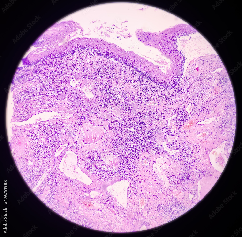 Pyriform fossa cancer: Invasive squamous cell carcinoma, moderately ...
