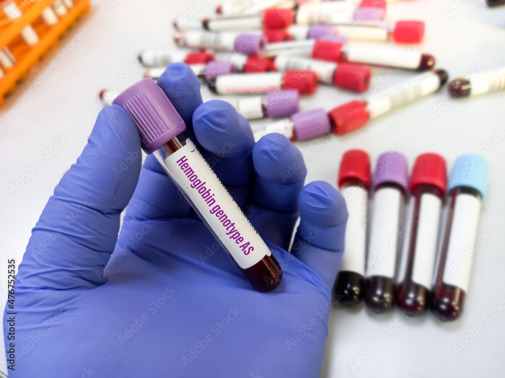 Blood sample tube with blood for Hemoglobin genotype AS-test ...