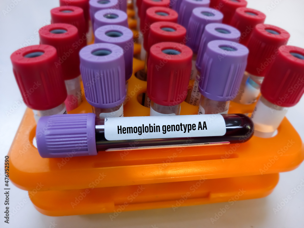 Blood sample tube with blood for Hemoglobin genotype AA test ...