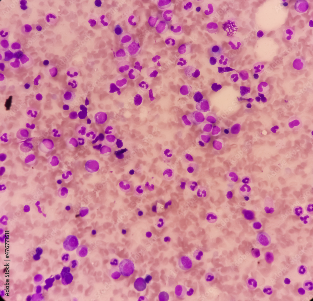 Microscopic view of bone marrow slide, acute myeloid leukemia(AML ...