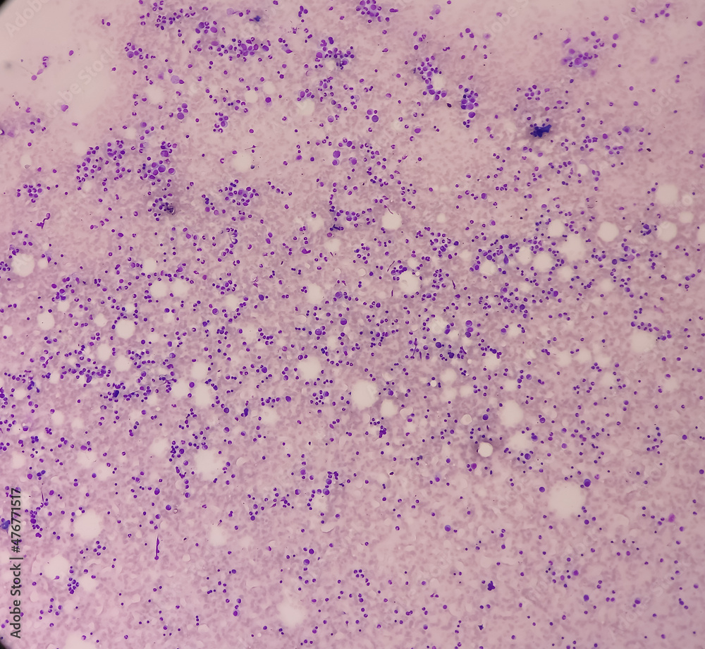 Microscopic view of bone marrow slide, acute myeloid leukemia(AML ...