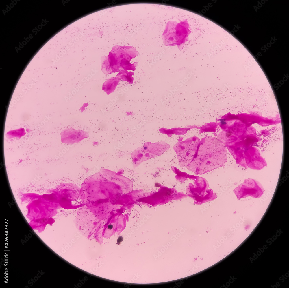 High Vaginal Swab (HVS): gram stained microscopic view of epithelial ...